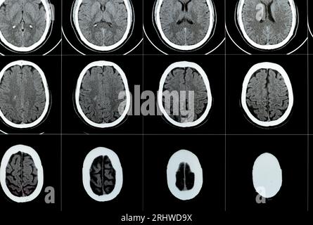 Multi slice CT scan of the brain showing Large brain stem and right ...