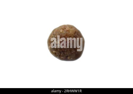 Large gallstone removed surgically after laparoscopic cholecystectomy ...