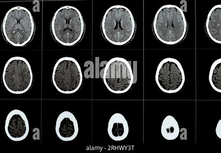 Brain CT scan showing brainstem cavernoma, right centrum semiovale ...