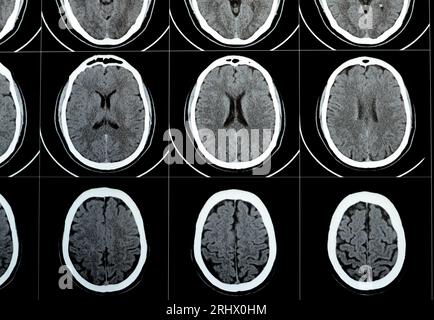 Multi slice CT scan of the brain showing Large brain stem and right ...
