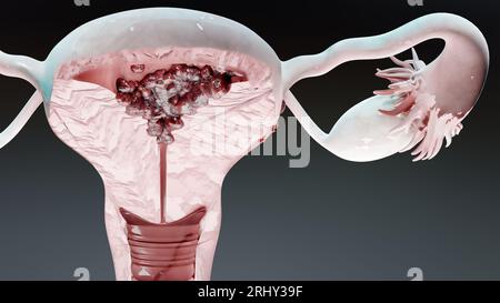 Uterine cancer , gynecological disease, medical concept, 3d rendering ...