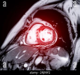 MRI heart or Cardiac MRI ( magnetic resonance imaging ) of heart RVOT ...