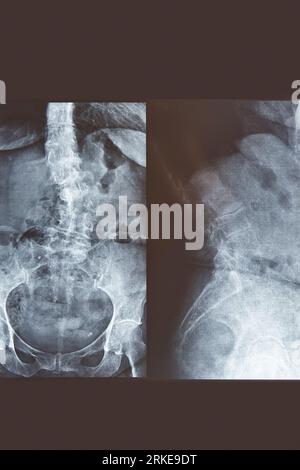 X-ray image of lumbar Spine or L-s spine Front view showing scoliosis ...