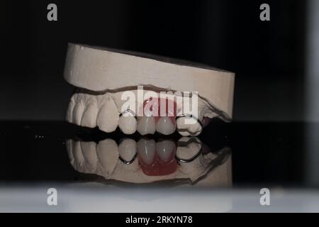 dental technician model removable prosthesis PAPM cobalt chrome resin ...