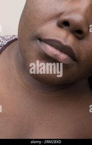 Brown skin with dark spots, hyperpigmentation on brown skin, african ...