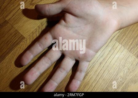 Warts Verrucas on the Hand Stock Photo - Alamy