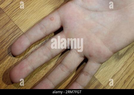 Warts Verrucas on the Hand Stock Photo - Alamy