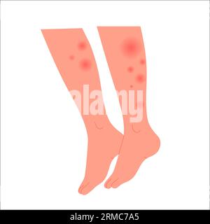 Human legs with skin allergy. Feet covered with red rash, atopic ...