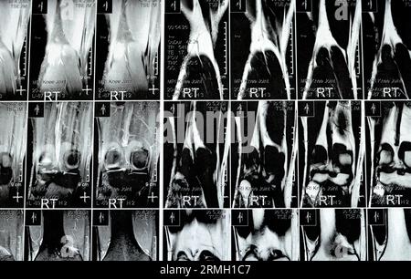MRI of the right knee showing mild joint effusion, with normal other ...