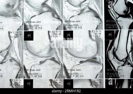 MRI of the right knee showing mild joint effusion, with normal other ...