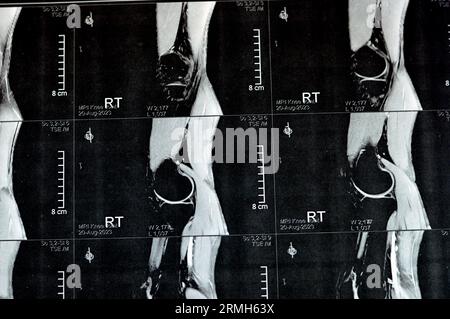 MRI of the right knee showing mild joint effusion, with normal other ...
