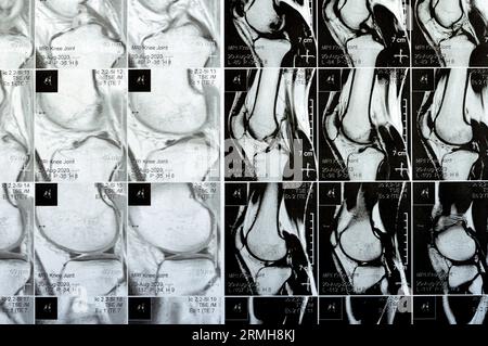 MRI of the right knee showing mild joint effusion, with normal other ...