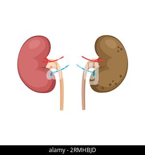 Healthy kidney and unhealthy disease kidney with polycystic. Check ...
