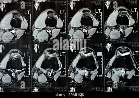 MRI of left knee joint showing minimal joint effusion, PHMM Posterior ...
