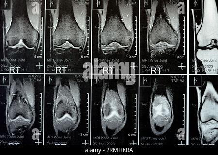 MRI of the right knee showing mild joint effusion, with normal other ...