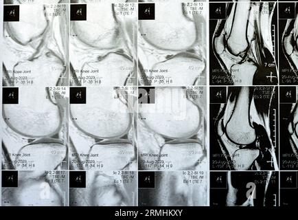 MRI of the right knee showing mild joint effusion, with normal other ...