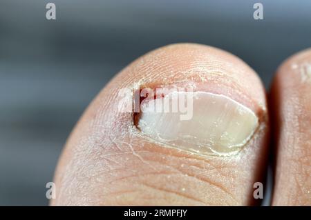Ingrown toenail of the big toe of the right foot is a common condition ...