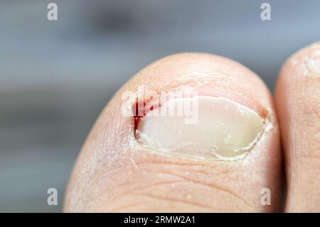 Swollen ingrown toe Stock Photo - Alamy
