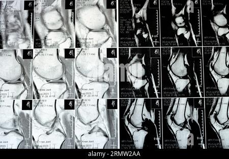 MRI of the right knee showing mild joint effusion, with normal other ...