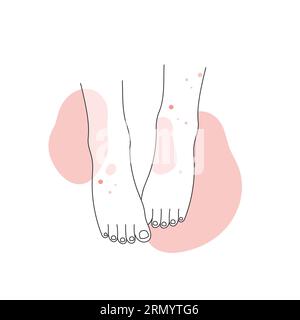 Human legs covered with red rash. Feet with allergic reaction, skin ...