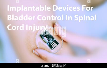 Implantable neurostimulation for bladder control: Devices that deliver ...