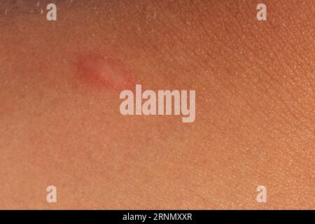 insect bite close-up on the skin near the knee. Allergic reaction ...
