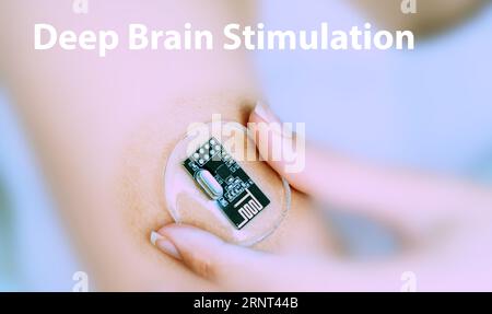Implantable deep brain stimulation system Vercise Genus shows for the ...