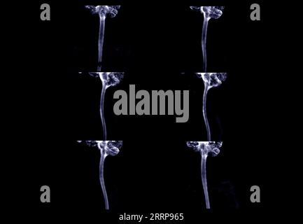 Cervical Spine Nerve Compression Causing Radiculopathy Stock Photo - Alamy
