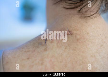 Medical stitches in woman's back after surgery Stock Photo - Alamy