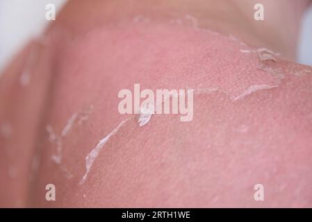 Effects of sunburn on human skin, exfoliation of dry skin, close-up ...