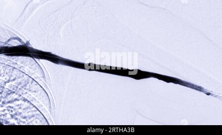 Image of Angioplasty, balloon angioplasty and percutaneous transluminal ...