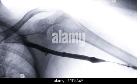 Image of Angioplasty, balloon angioplasty and percutaneous transluminal ...