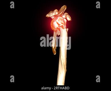 CT scan of head of humerus 3D of Computed Tomography Volume Rendering ...