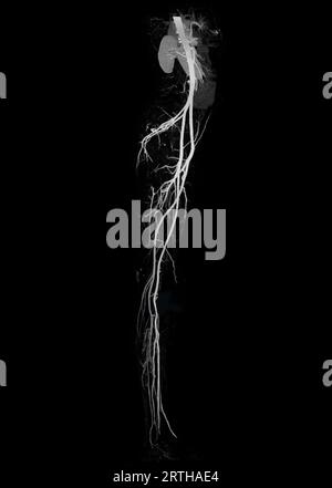 Femoral Angiogram of femoral artery showing femoral artery vessel ...