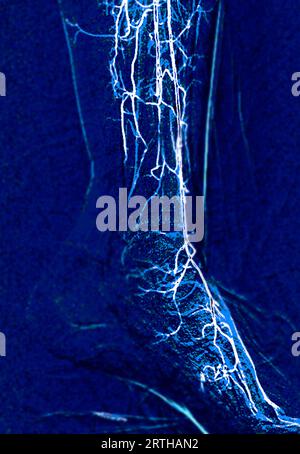 Femoral Angiogram of femoral artery showing femoral artery vessel ...