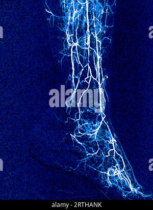 Femoral Angiogram of femoral artery showing femoral artery vessel ...