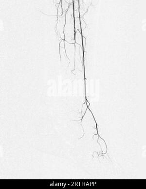 Femoral Angiogram of femoral artery showing femoral artery vessel ...