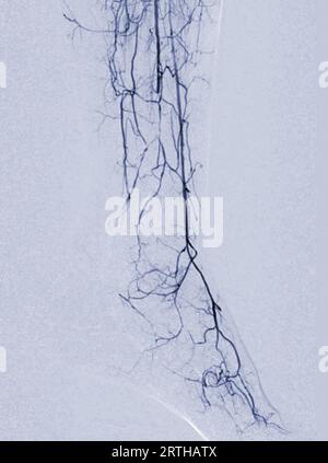 Femoral Angiogram of femoral artery showing femoral artery vessel ...