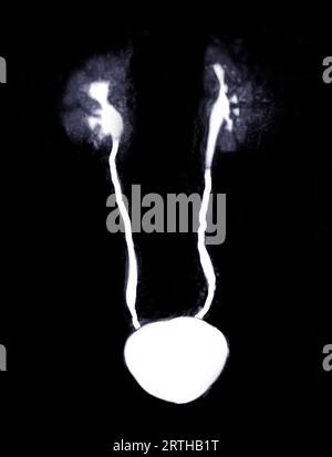 Magnetic resonance urography (MR urography) is a MRI study that ...