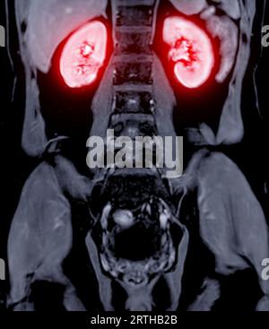 Magnetic resonance urography (MR urography) is a MRI study that ...