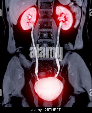 Magnetic resonance urography (MR urography) is a MRI study that ...