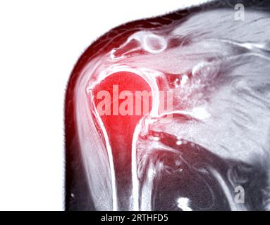 Magnetic Resonance Imaging or MRI of Shoulder Joint for diagnostic ...
