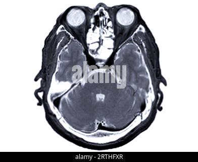 MRI scan of the brain for detect Brain diseases sush as stroke disease, Brain tumors and ...