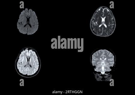 MRI brain scan axial Diffusion technique for detect Brain diseases sush ...