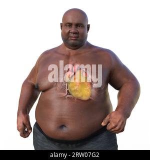 Overweight man with enlarged heart, illustration Stock Photo - Alamy