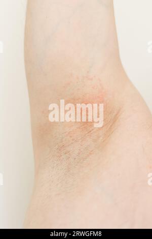 Allergy underarm. Cropped photo of irritation, inflammation on the ...