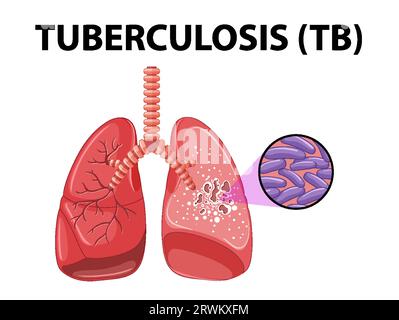 Illustration of human lung anatomy showcasing tuberculosis infection ...