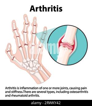 Learn about arthritis stages through a science education infographic ...