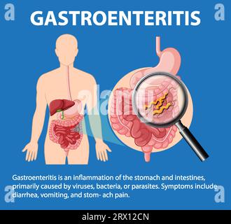 An infographic illustrating gastroenteritis, its causes, and symptoms ...