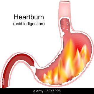 Esophageal gastric reflux acid indigestion. Gastrointestial stomach ...